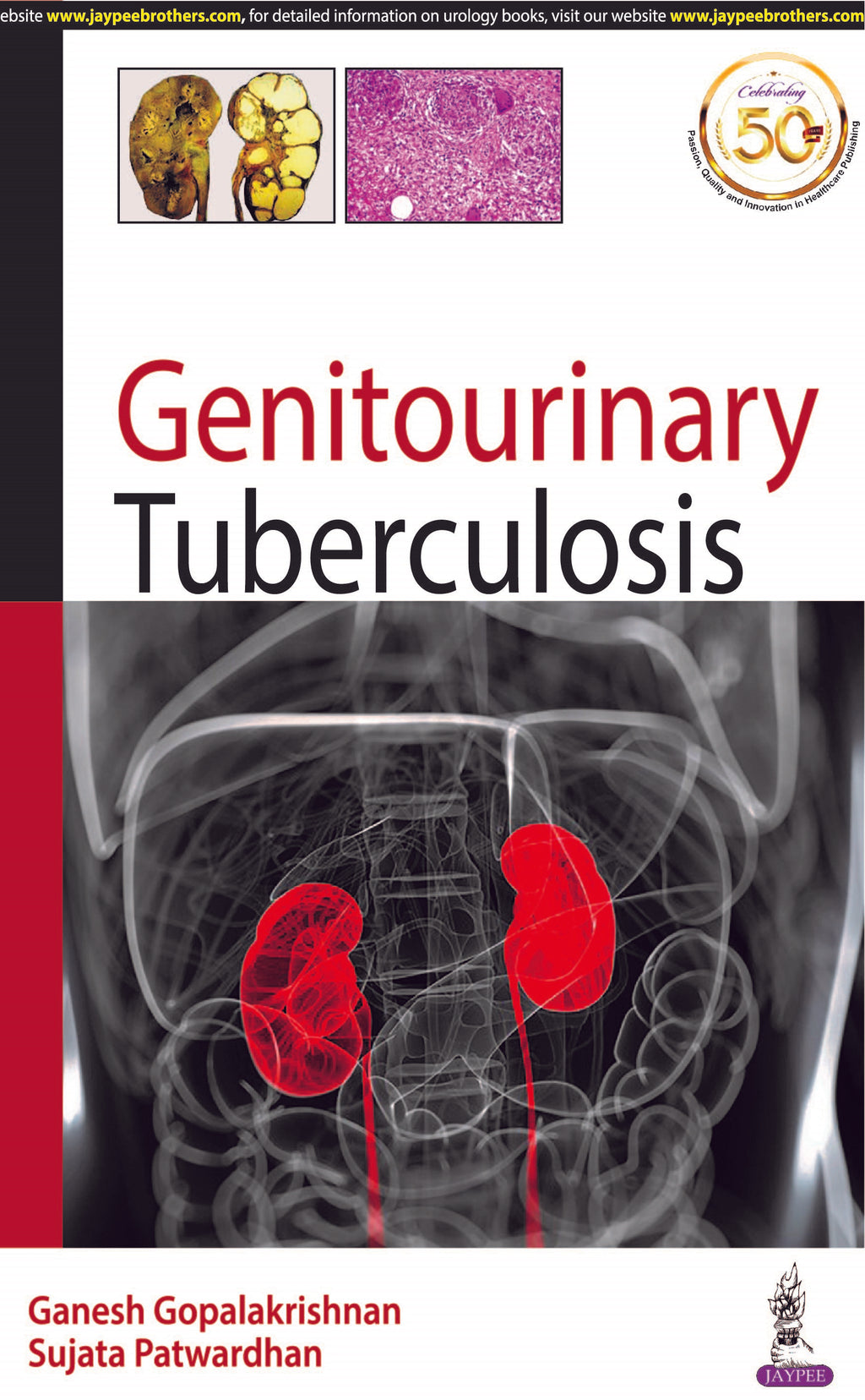 Genitourinary Tuberculosis – BookStation